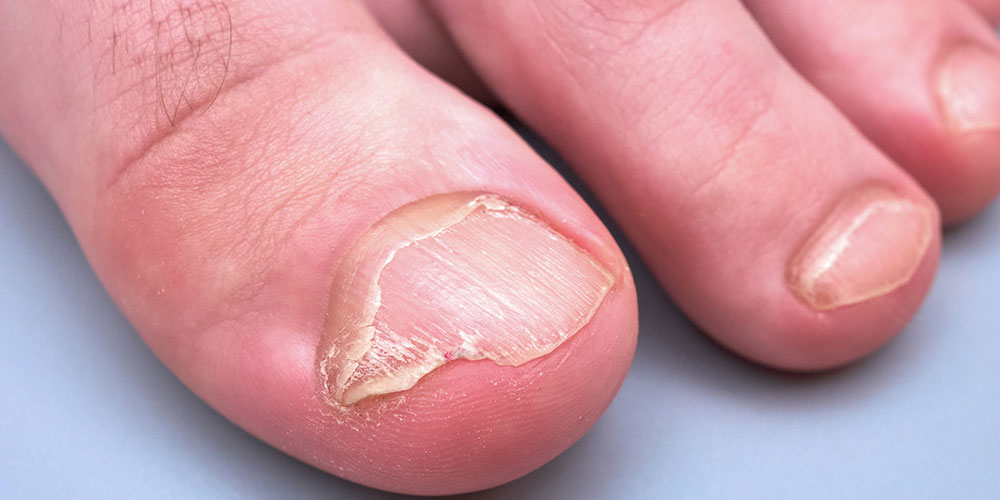 Conectando Pacientes | Psoriasis ungueal: qué es y cómo tratarla