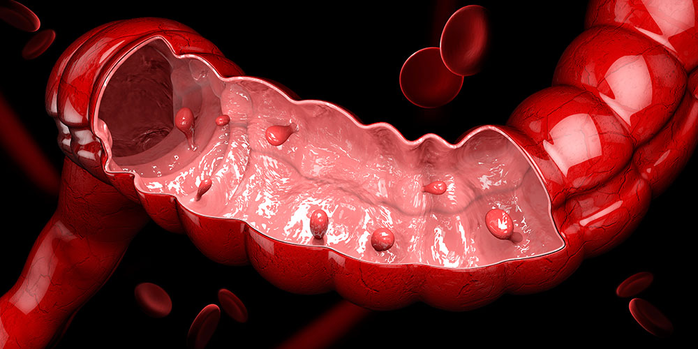 Conectando Pacientes | ¿Qué son los pólipos de colon?