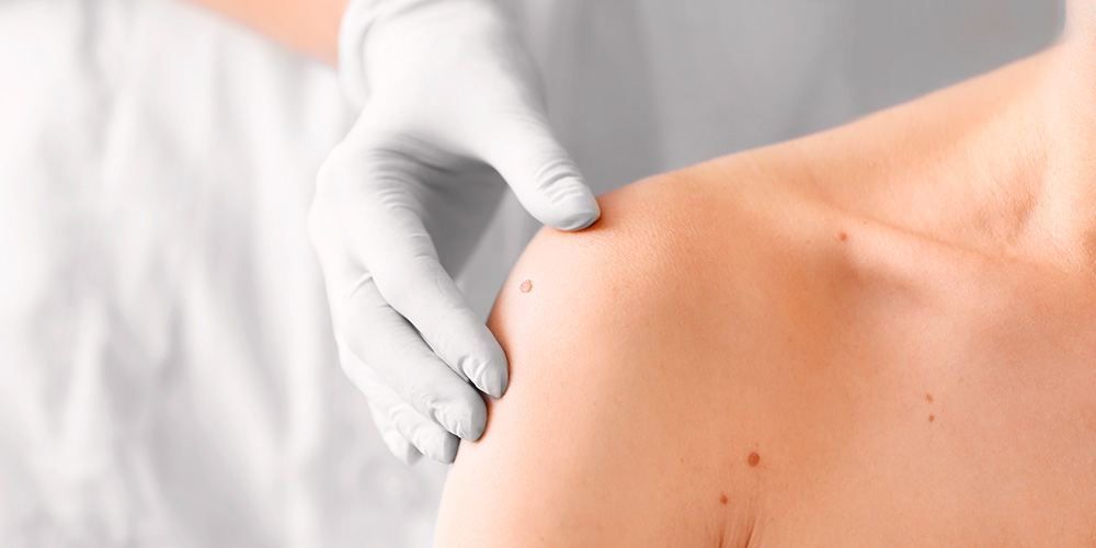 Conectando Pacientes | Tipos de injertos cutáneos y cuales son los más ...